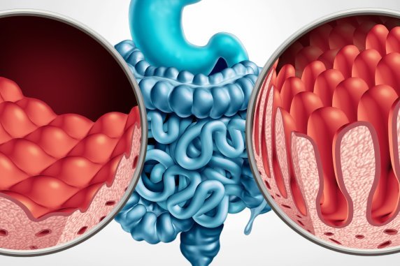 ¿Puede diagnosticarse la enfermedad celíaca en adultos sin biopsia ...